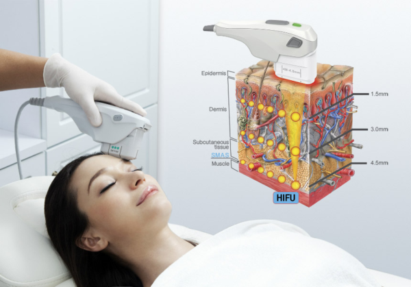 HIFU and MFU: Understanding the Differences and Making the Right Choice ...