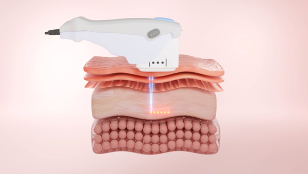 HIFU and MFU: Understanding the Differences and Making the Right Choice ...